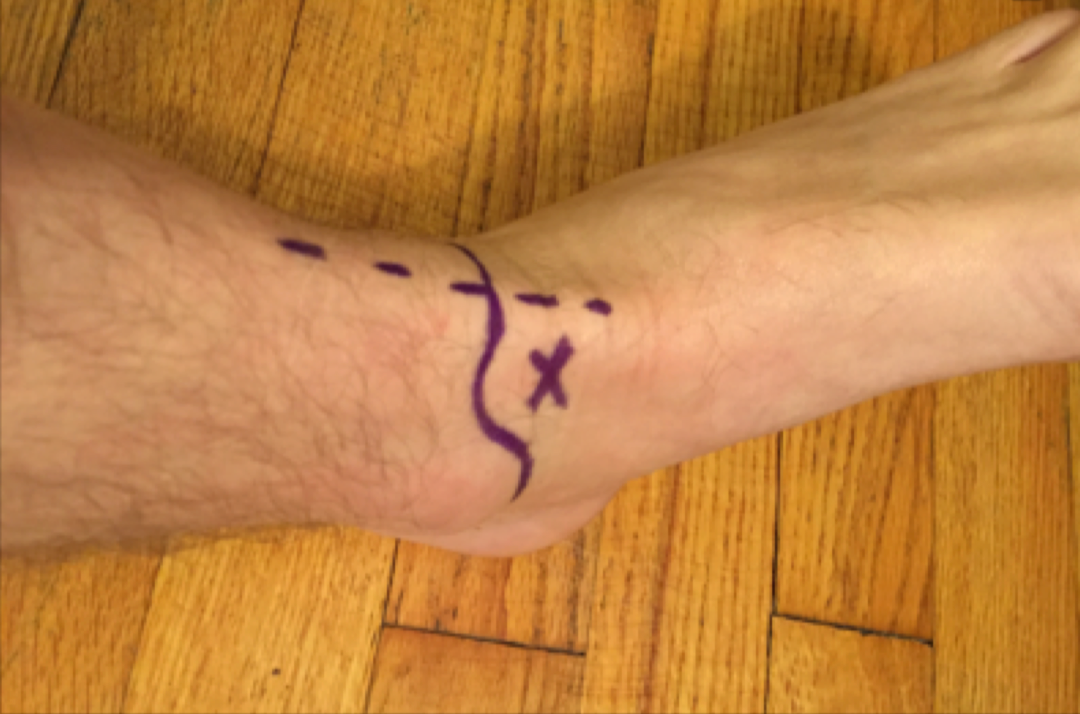 What is Useful in the ED to Help Diagnose or Rule Out Septic Arthritis ...