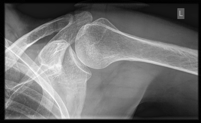 Xray Shoulder Normal