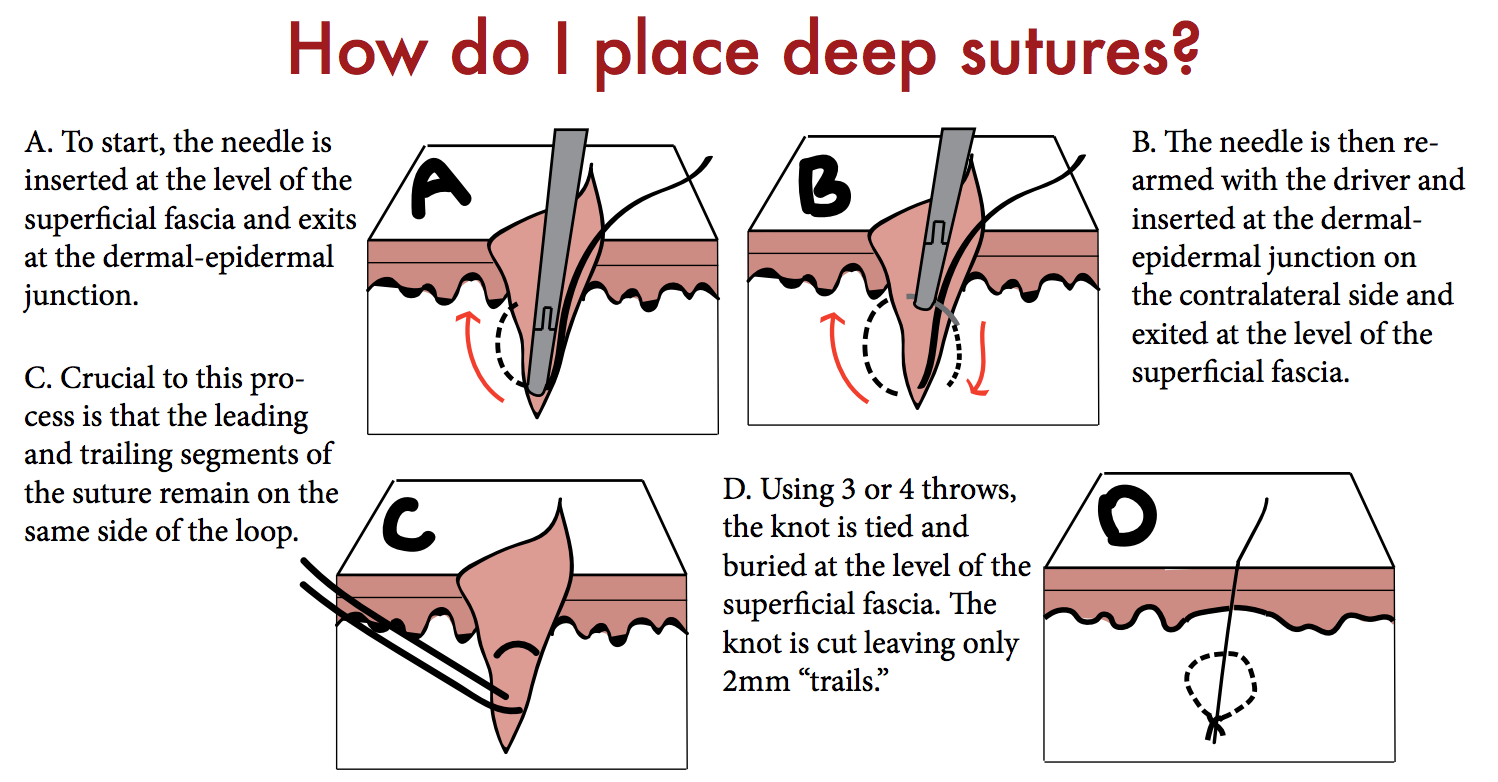 Closing The Gap Deep Sutures Taming The SRU Closing The Gap Deep Sutures Taming The SRU