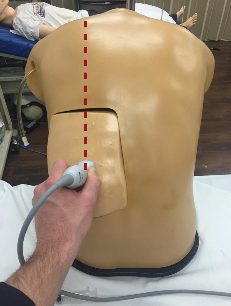 Thoracentesis — Taming the SRU
