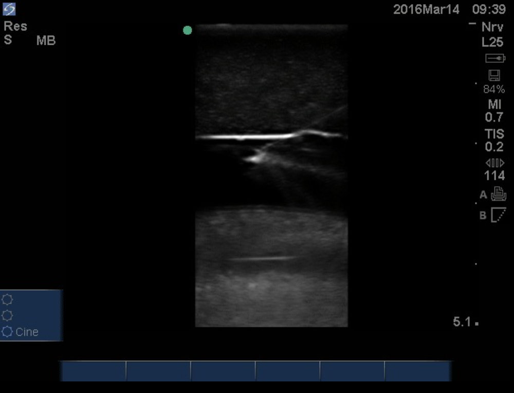 Thoracentesis — Taming the SRU