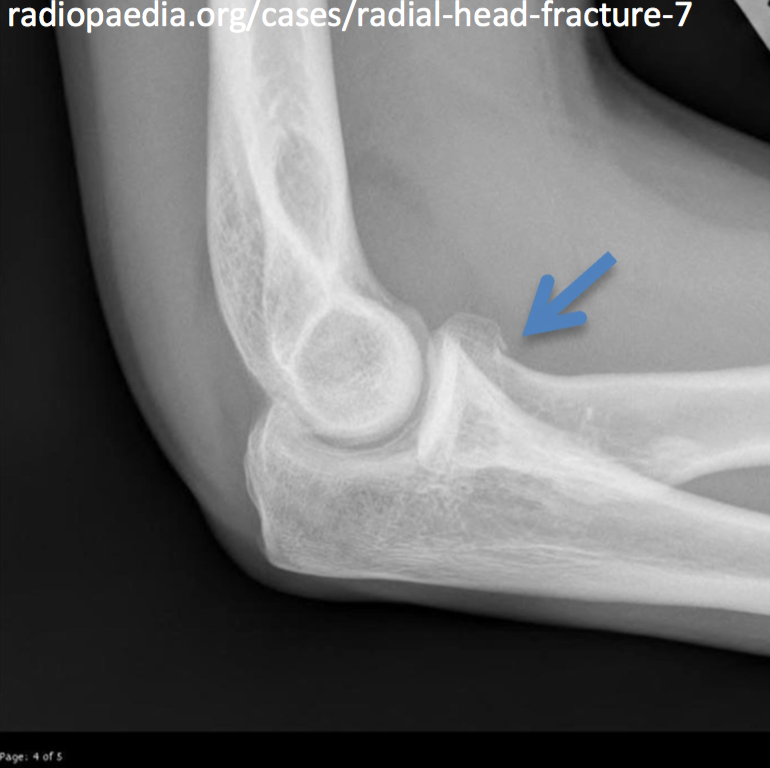 Interpreting Elbow and Forearm Radiographs — Taming the SRU