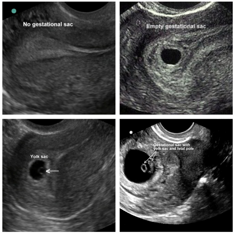 Normal Pelvic Ultrasound Pelvic Ultrasound NovaMed Urgent Care In