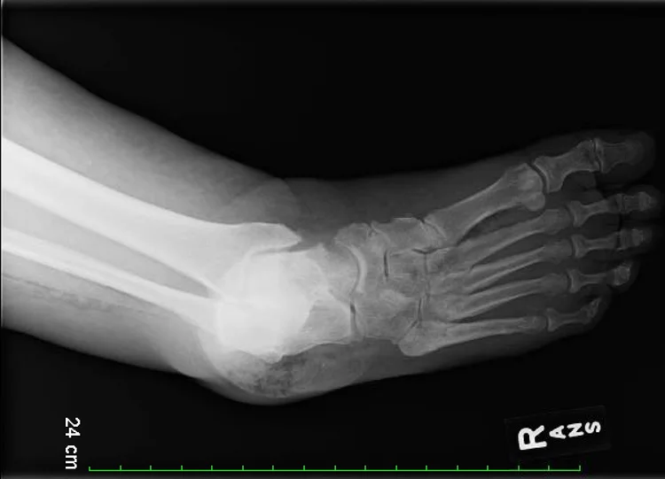 Annals of B-Pod: A Dangerous Case of Foot Pain — Taming the SRU