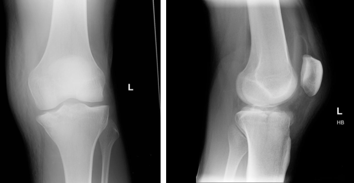 Clinical Approach to Knee Radiographs — Taming the SRU