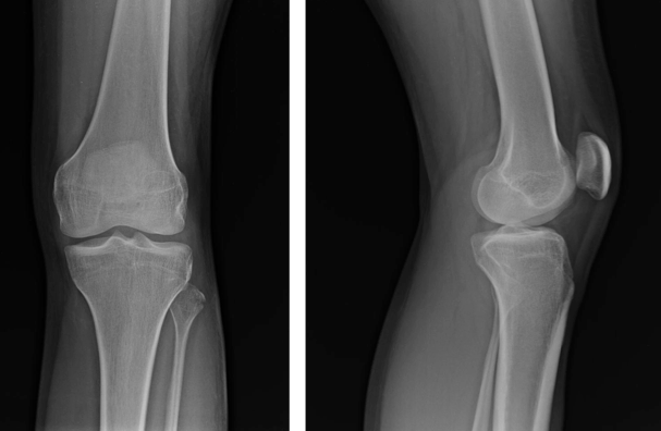 Clinical Approach to Knee Radiographs — Taming the SRU