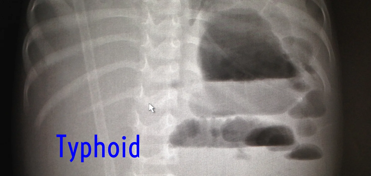 Typhoid — Taming the SRU