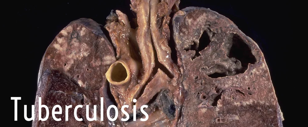 Tuberculosis — Taming the SRU