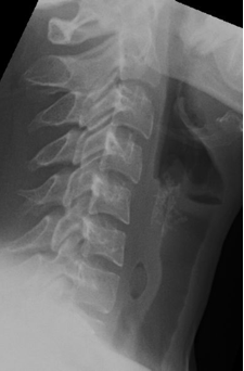 Soft Tissue Neck Radiographs - Are They Useful? — Taming the SRU