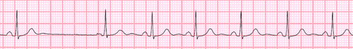 Heart Blocks: A Primer — Taming the SRU