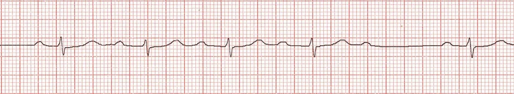 Heart Blocks: A Primer — Taming the SRU