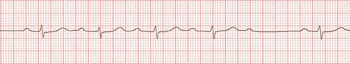 Heart Blocks: A Primer — Taming the SRU