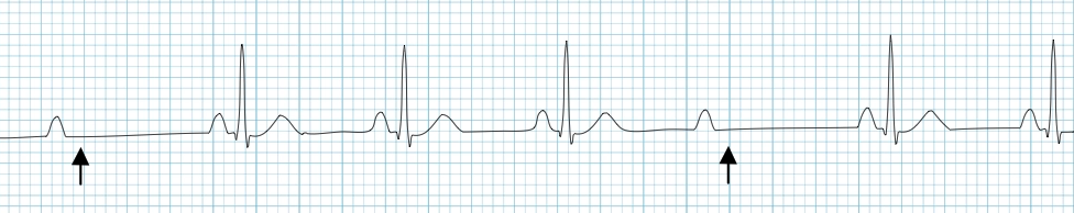 Heart Blocks: A Primer — Taming the SRU