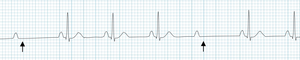 Heart Blocks: A Primer — Taming the SRU