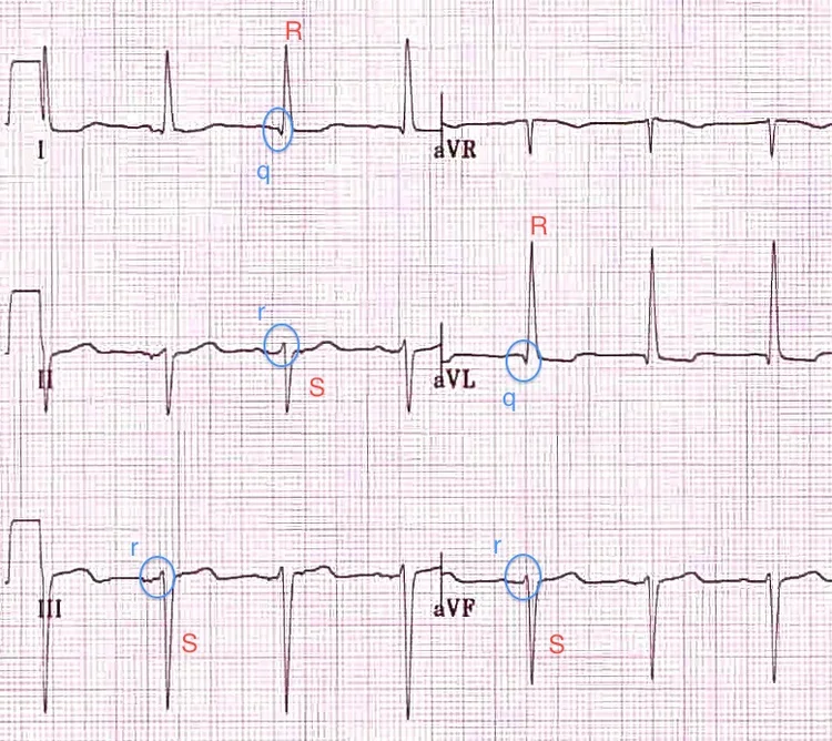 Heart Blocks: A Primer — Taming the SRU