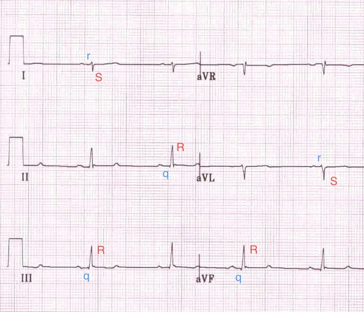 Heart Blocks: A Primer — Taming the SRU