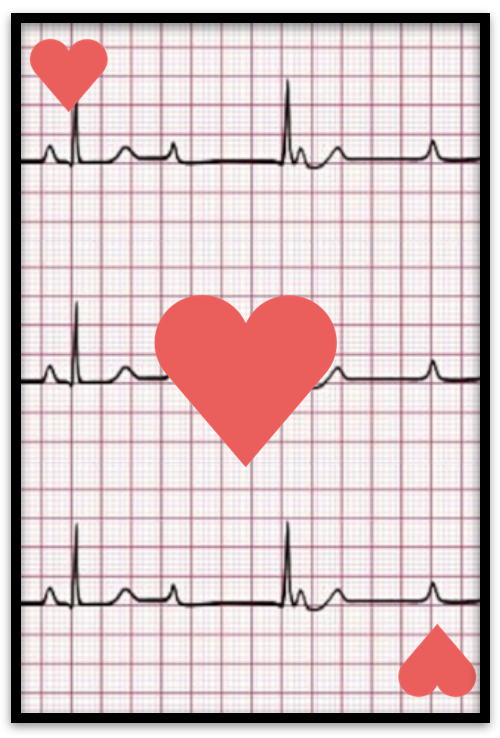 Heart Blocks: A Primer — Taming the SRU