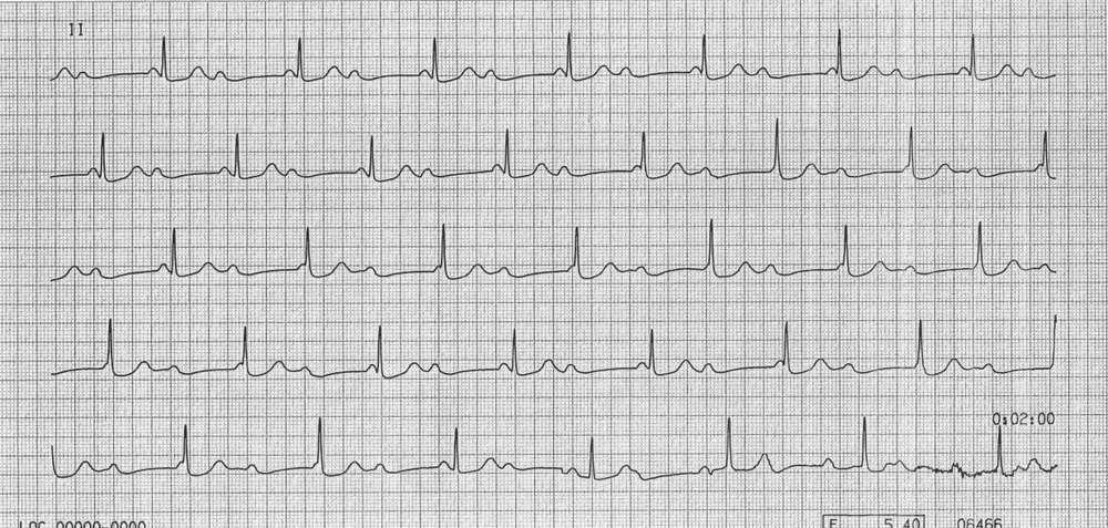Back on the Block - Heart Blocks Part 2 — Taming the SRU