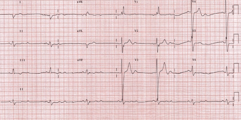 Back on the Block - Heart Blocks Part 2 — Taming the SRU