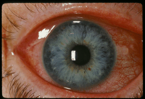 Conjunctivitis — Taming the SRU