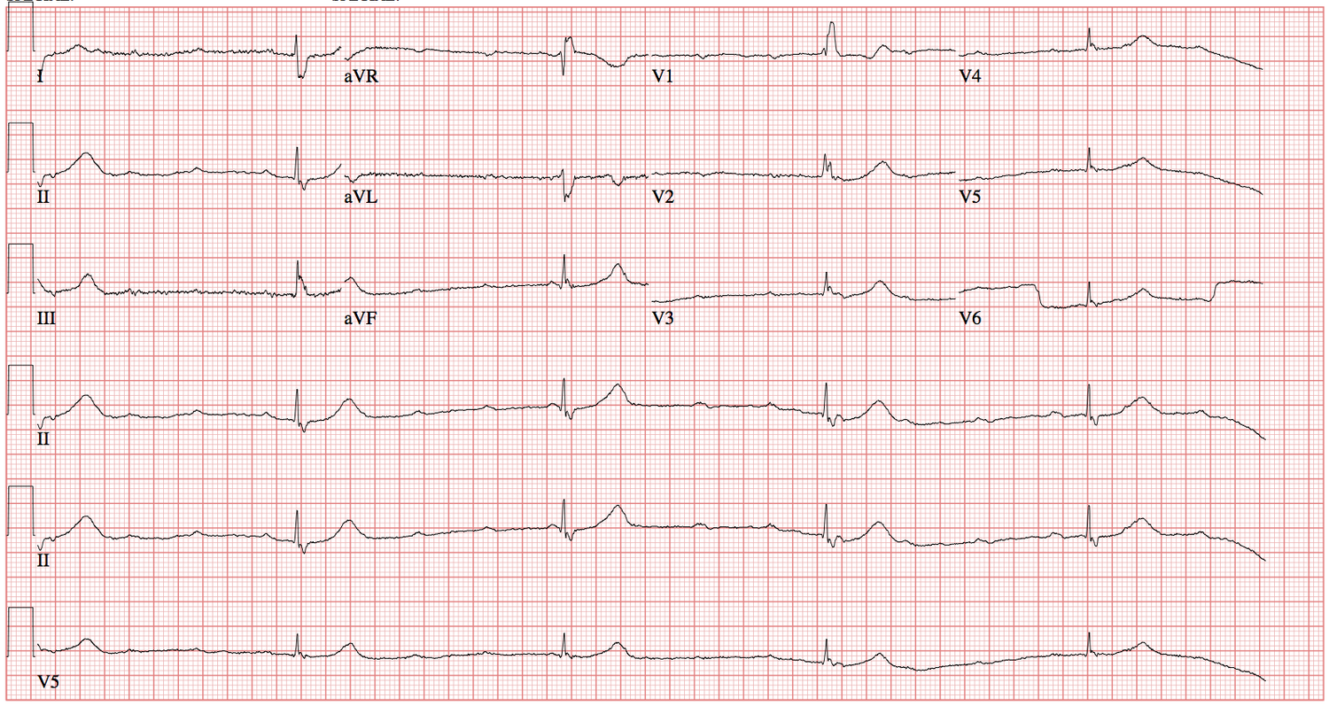 ECG Education — Taming the SRU