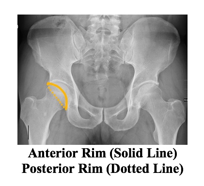 Back to Basics: Pelvic XRays — Taming the SRU