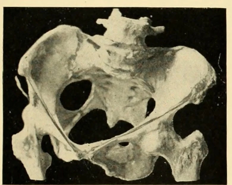 Back to Basics: Pelvic XRays — Taming the SRU