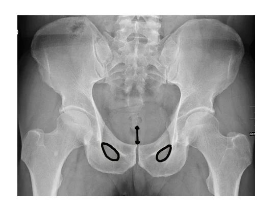 Back to Basics: Pelvic XRays — Taming the SRU