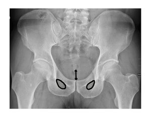 Back to Basics: Pelvic XRays — Taming the SRU