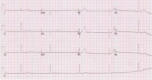 EKG Toxicology — Taming the SRU