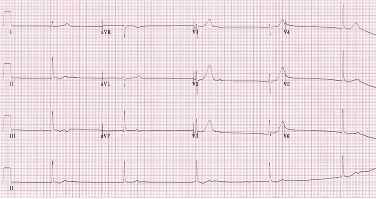 EKG Toxicology — Taming the SRU