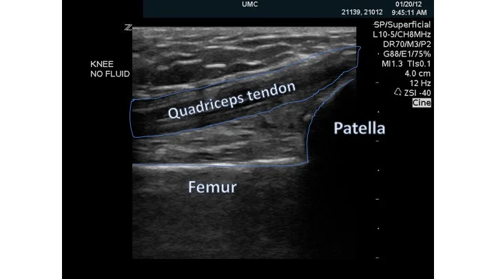 US - Pre-patellar bursitis: Ultrasound of the Month — Taming the SRU