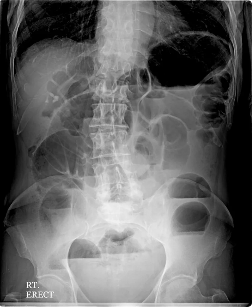 The Abdominal XRay A Relic Or A Reliable Tool Taming The SRU