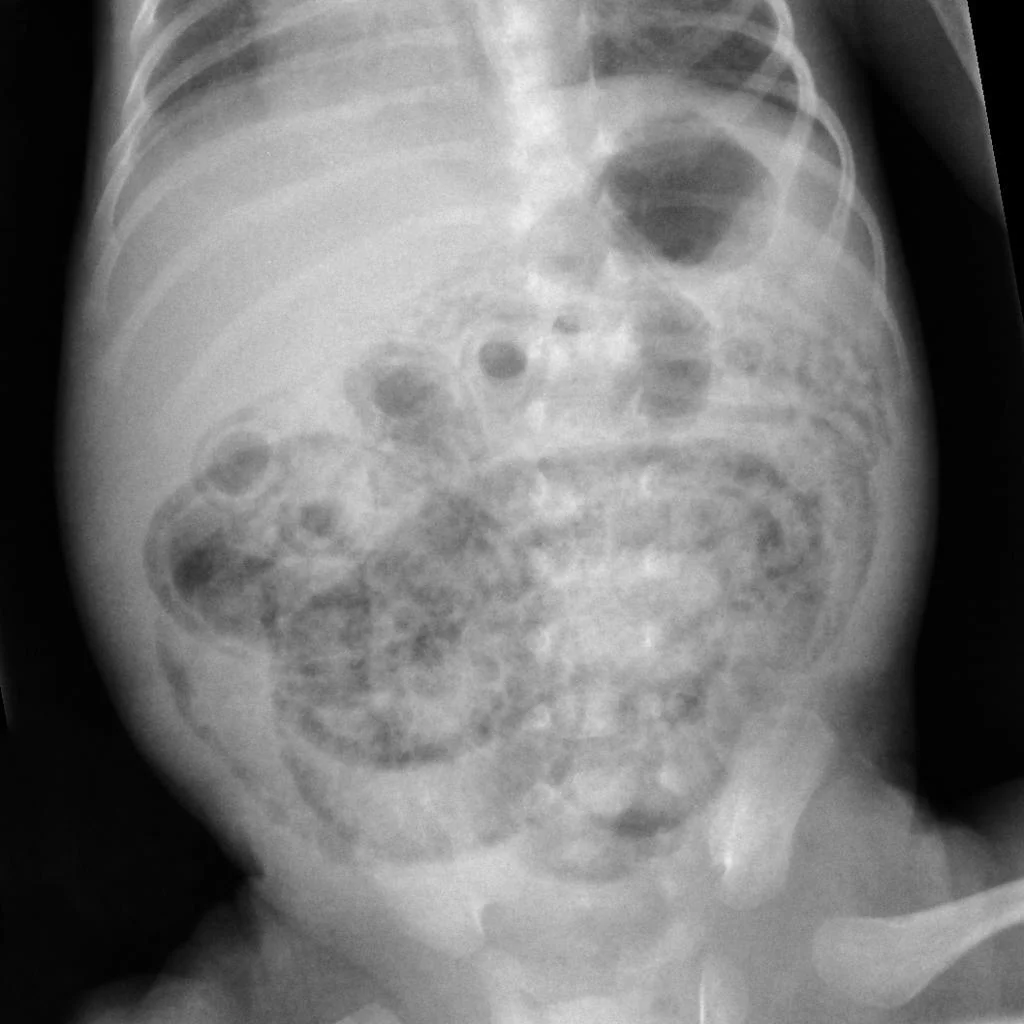 The Abdominal XRay: A relic or a reliable tool? — Taming the SRU