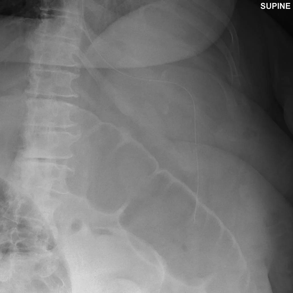The Abdominal XRay: A relic or a reliable tool? — Taming the SRU