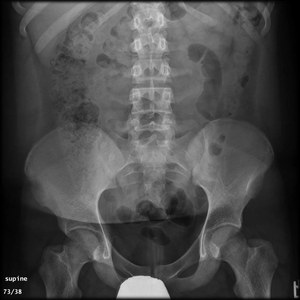 The Abdominal XRay: A relic or a reliable tool? — Taming the SRU