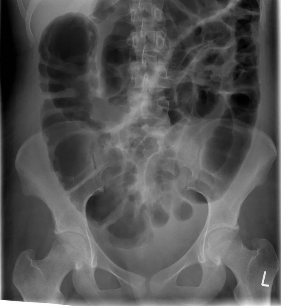 The Abdominal XRay: A relic or a reliable tool? — Taming the SRU