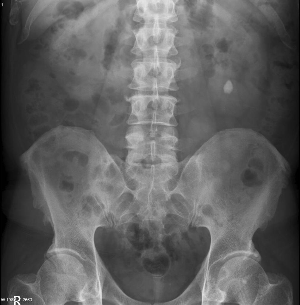 The Abdominal XRay: A relic or a reliable tool? — Taming the SRU