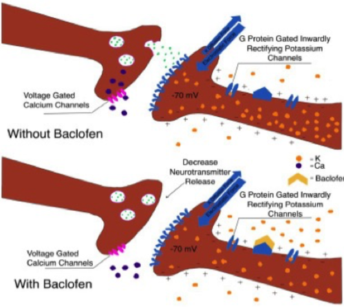 Annals of B-Pod: Baclofen Pump Failure — Taming the SRU