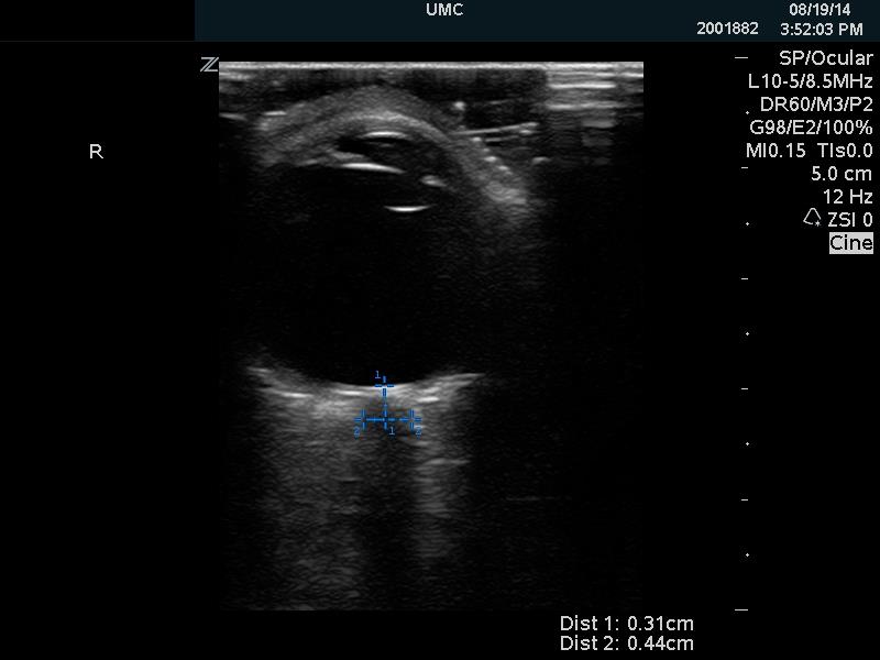 US - Elevated ONSD: Ultrasound of the Month — Taming the SRU