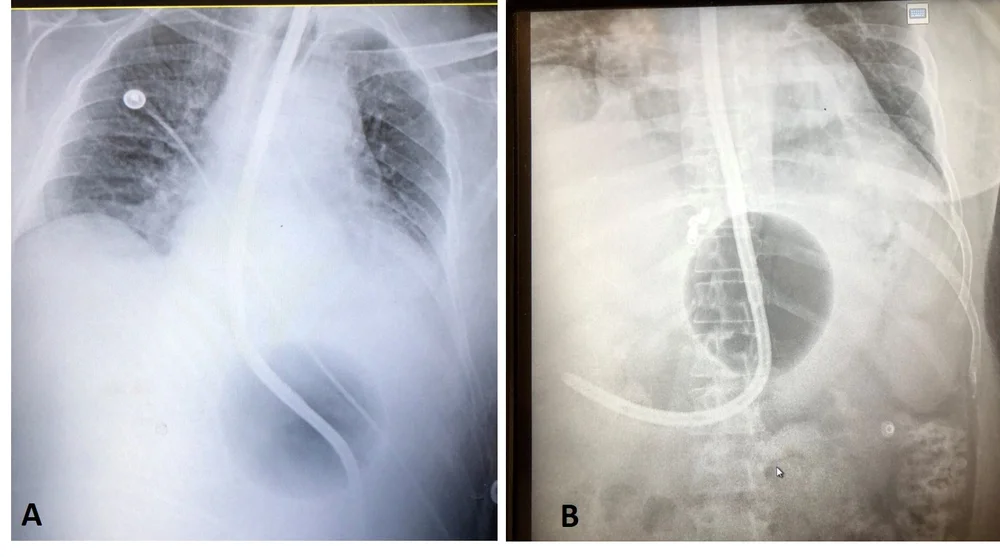 Air Care Series: Balloon Tamponade of Variceal Hemorrhage — Taming the SRU