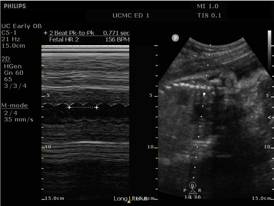 US - Pregnancy The LABUR protocol: Ultrasound of the Month — Taming the SRU