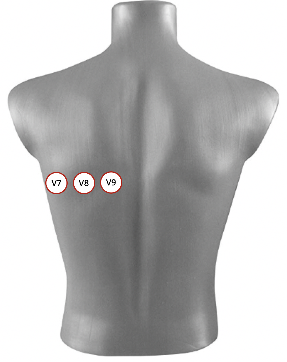 Diagnostics: Alternative EKG Leads — Taming the SRU