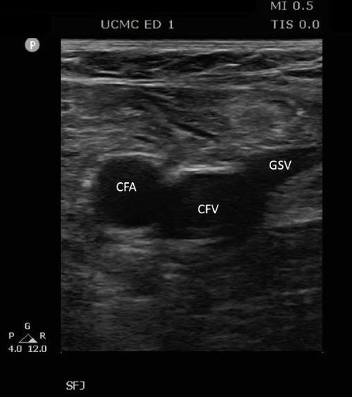 Scanning School - LE Venous — Taming the SRU