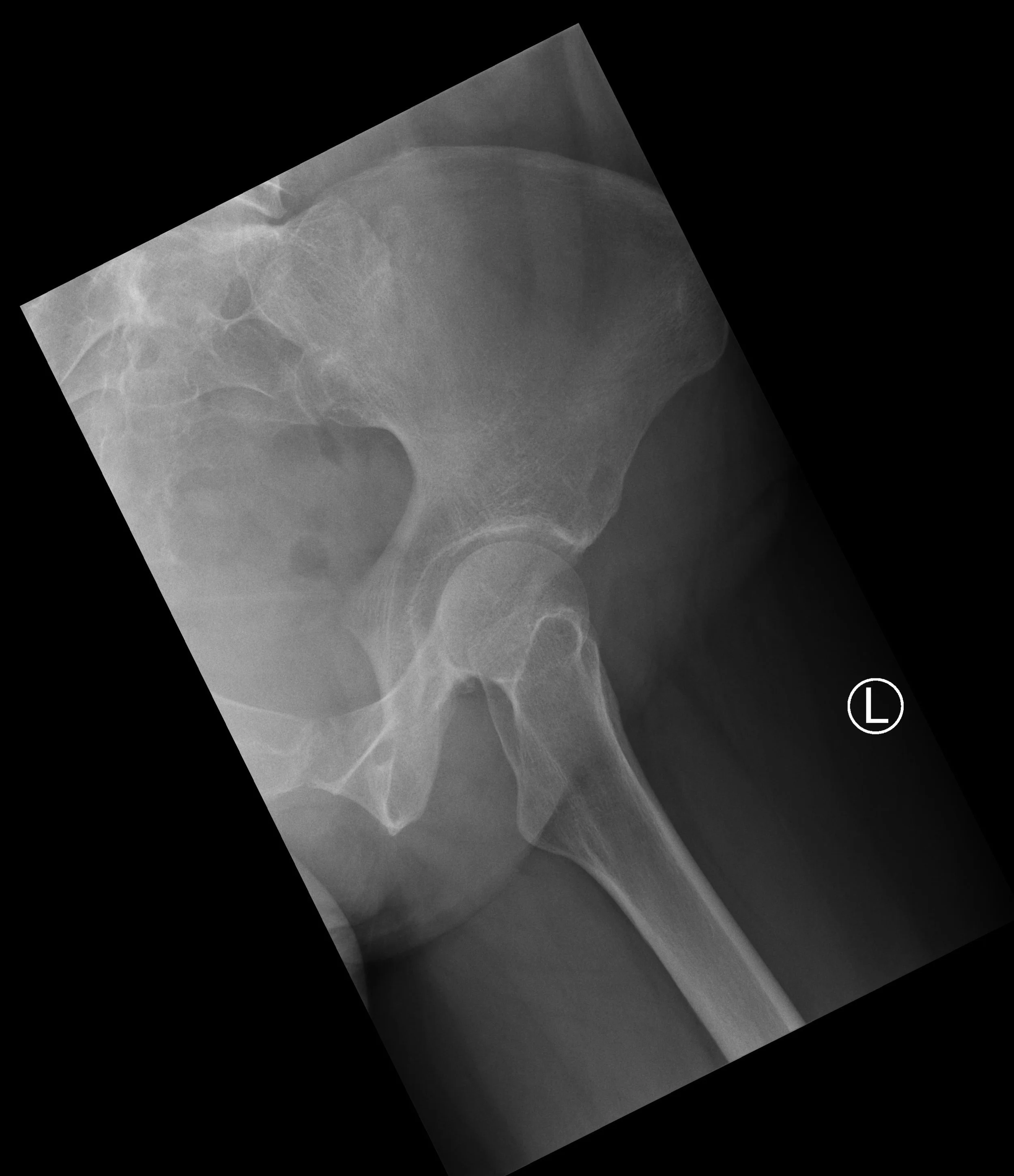 Normal Pediatric Ankle Xray