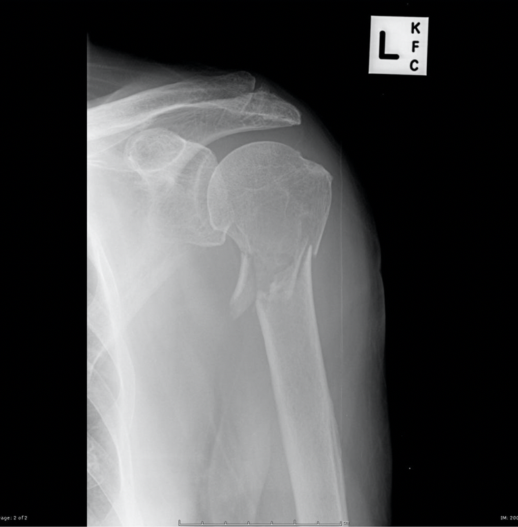 X-ray Vision - Shoulders and Elbows — Taming the SRU