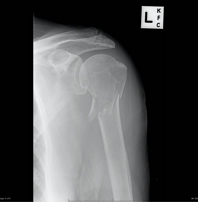 X ray Vision Shoulders And Elbows Taming The SRU X ray Vision Shoulders And Elbows Taming The SRU