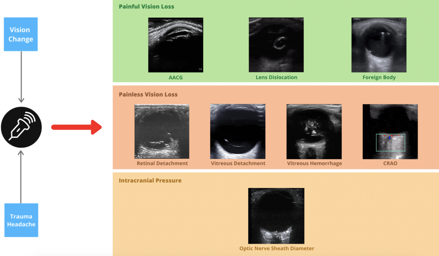 Diagnostics: Ocular Ultrasound — Taming the SRU