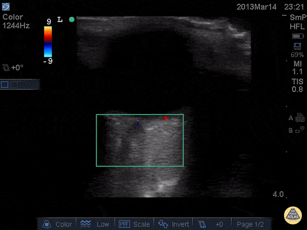 Diagnostics: Ocular Ultrasound — Taming the SRU