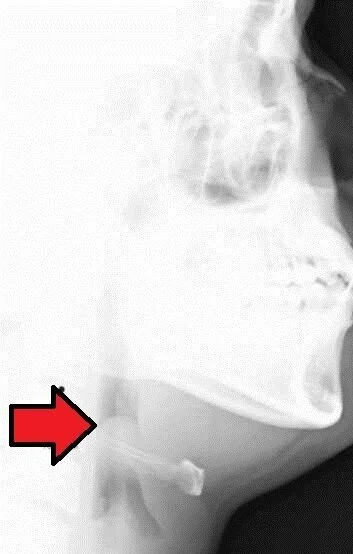 More Than a Sore Throat: Acute Epiglottitis — Taming the SRU